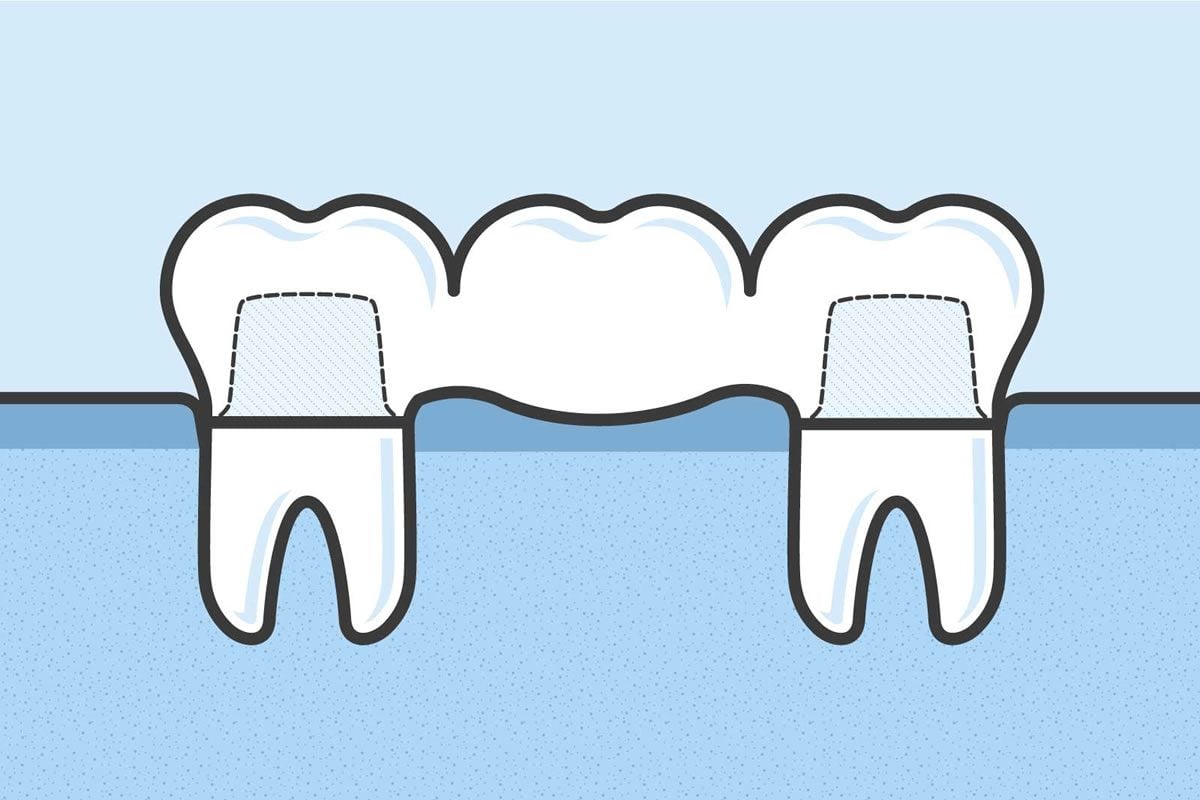 What are Dental Bridges and How Do They Work? - From 123Dentist